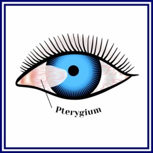 Pterygium Treatment Las Vegas | Pterygium Henderson | Nevada Eye Physicians